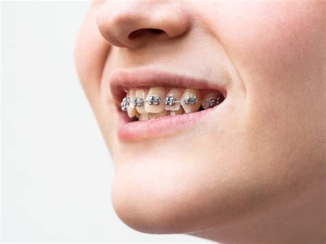 Orthodontic Dental Braces On Teeth Of Upper Jaw Stock Image Image Of