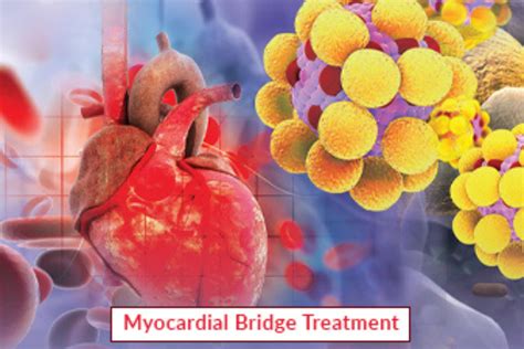 Myocardial Bridge ကုသမှု ကျွမ်းကျင်သော နှလုံးစောင့်ရှောက်မှု