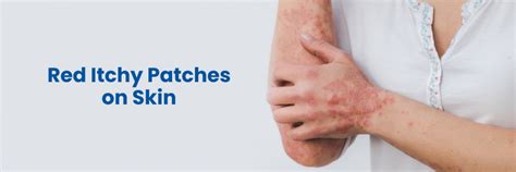Red Itchy Patches On Skin Causes Symptoms And Treatments