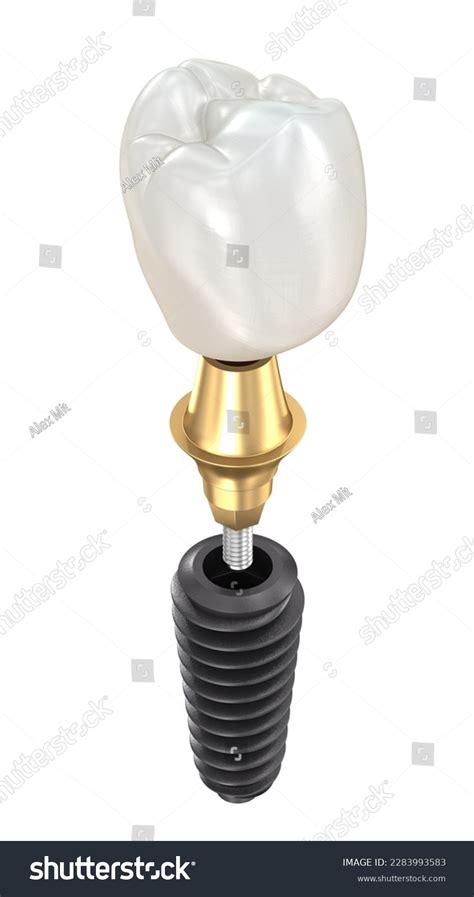 Dental Implant Ceramic Crown Medically Accurate Stock Illustration