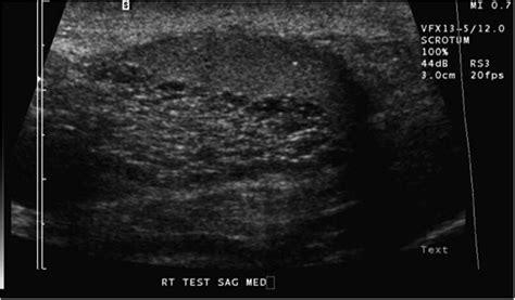 Ultrasound Evaluation Of Scrotal Pathology Radiologic Clinics