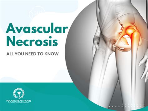 Avascular Necrosis Osteonecrosis What Is Stages Causes Symptoms