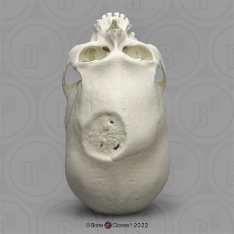 Peruvian Male Skull With Cranial Binding And Trephination Bone Clones Osteological Reproductions