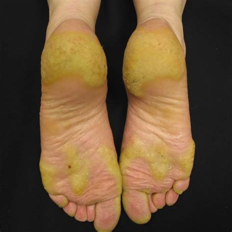 Why My Feet Are Yellow At Tamara Juarez Blog
