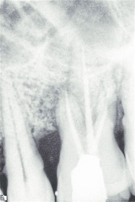 Post Endodontic Treatment Radiograph Download Scientific Diagram