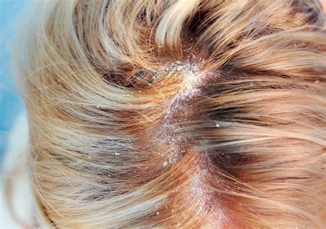 Why Do I Have Dry Patches Of Skin On The Face And Body — Moody Sisters