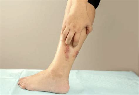 Trophic Ulcers Causes Diagnosis And Treatment In The Best Clinics