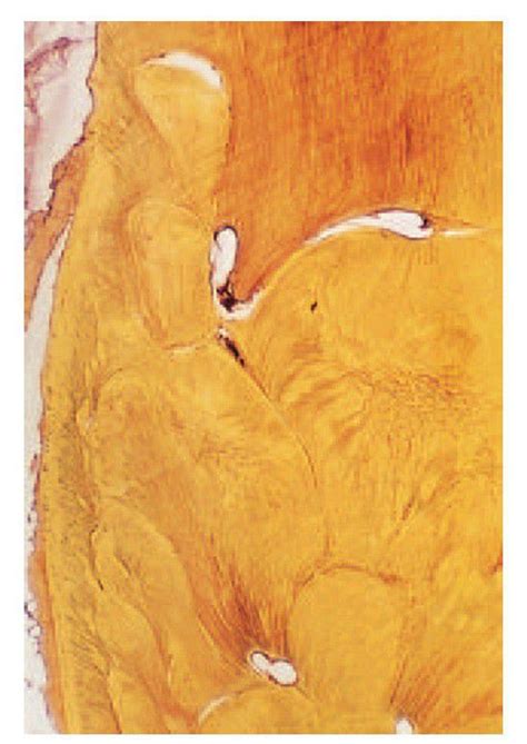 Dentinal Dysplasia Medizzy