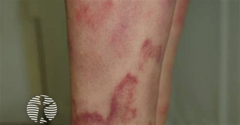 Urticarial Vasculitis Image