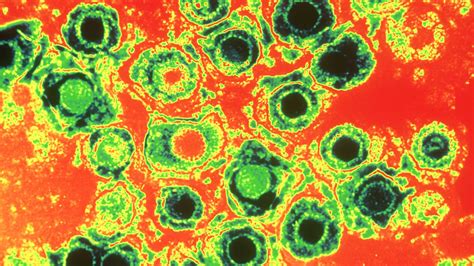 Genital Herpes Causes Hsv 1 And Hsv 2