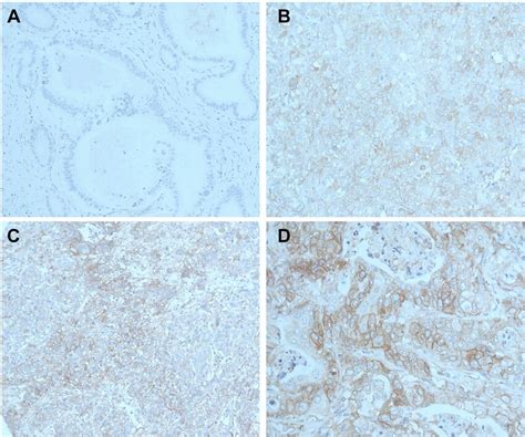 Immunohistochemistry Staining For Integrin Beta1 Itgb1 Negative