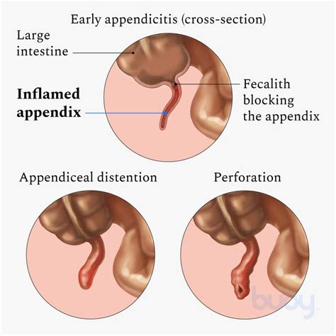 Inflamed Appendix