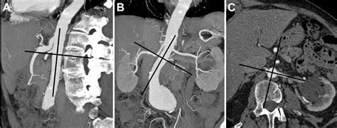 Figure 1 From Ct Angiography In Stent Graft Sizing Impact Of Using