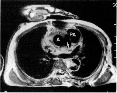 Figure 1 From Aortic Root Abscess With Fistula Formation Semantic Scholar