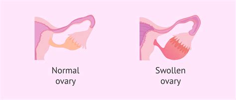 Ovaritis