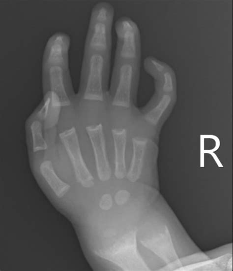 Radiología Musculoesquelética X Enfermedades Metabólicas óseas