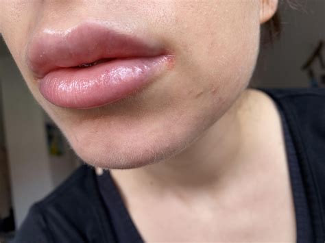 What Is This Angular Cheilitis Raccutane