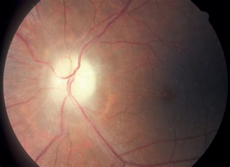 What Is High Intraocular Pressure Iop And How To Treat It Seven