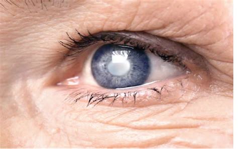 Fg Trains Health Professionals In Glaucoma Guideline