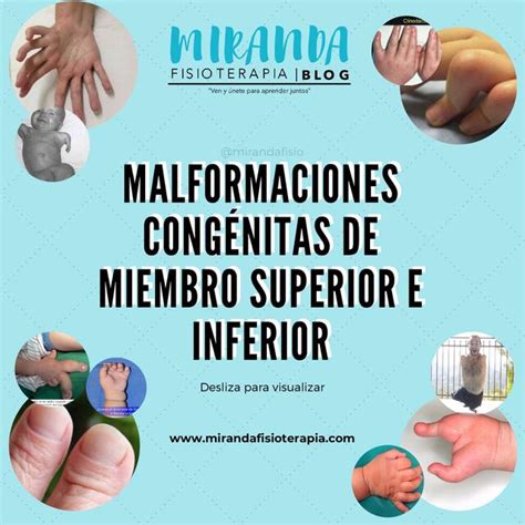 Malformaciones Congénitas De Miembro Superior E Inferior Miranda