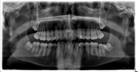 Supernumerary Teeth In Nose