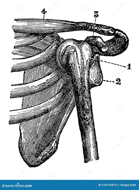 Shoulder Dislocation Cartoon Vector 53691677