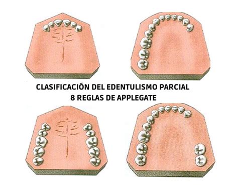PrÓtesis Dental Clasificación Del Edentulismo Parcial 8 Reglas De