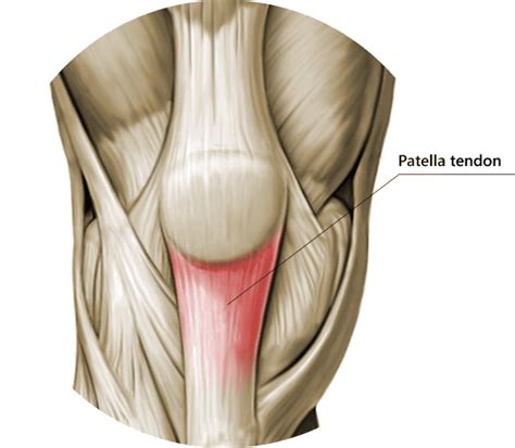 Patellar Tendonitis
