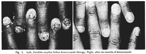 Table 1 From A Case Of Chronic Mucocutaneous Candidiasis Successfully Treated With Ketoconazole