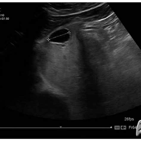 Sentinel Lymph Node Lymphoscintigraphy Which Shows 2 Inguinal Lymph