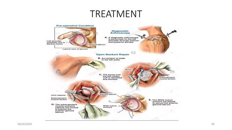 Pathology And Management Of Recurrent Shoulder Dislocation Pptx