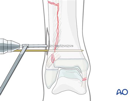 Syndesmotic Transfixation With Suture And Button Suspensory Fixation