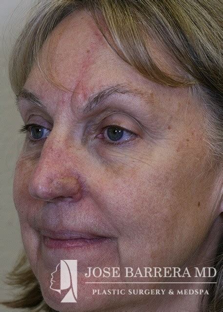 Reconstructive Nasal Case 8989 Dr Jose Barrera San Antonio Facial Plastic Surgeon And Ent