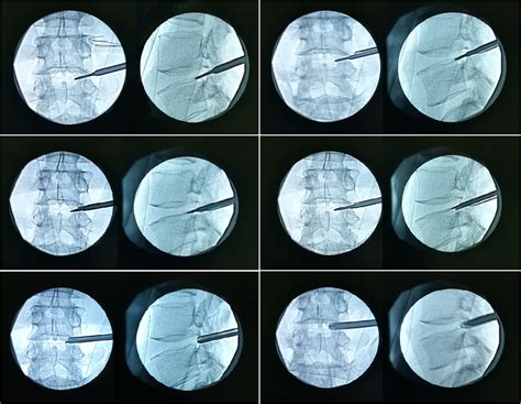 Illustrated Case 3 Intraoperative Fluoroscopy Of The Operative Region