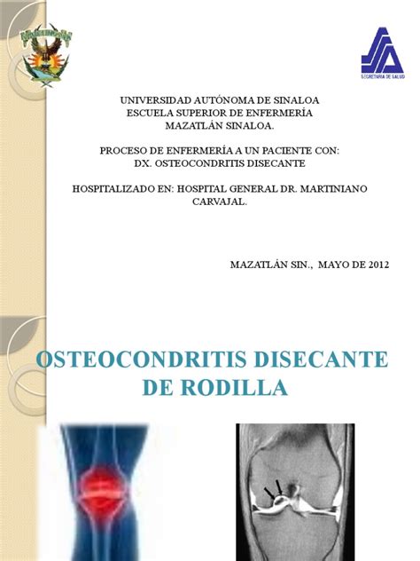 Osteocondritis Disecante Pdf Rodilla Articulación