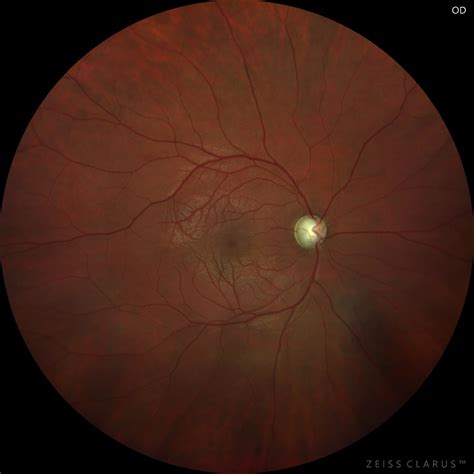 Glaucoma Juvenil Retina Club Retina Club