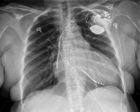 X Ray Heart Attack