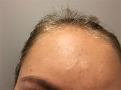 Strange Skin Texture On Epiduo Side Effect Picture Prescription Acne Medications