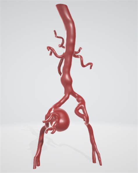 Obj File 3d Left Common Iliac Artery Aneurysm From Real Case 1 ⬅️