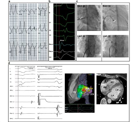 A A 12 Lead Ecg Of Clinical Vt B Intracardiac Egm At The Basal