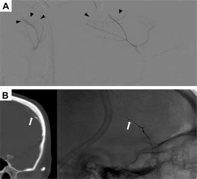 Middle Meningeal Artery Embolization For Subdural Hematoma