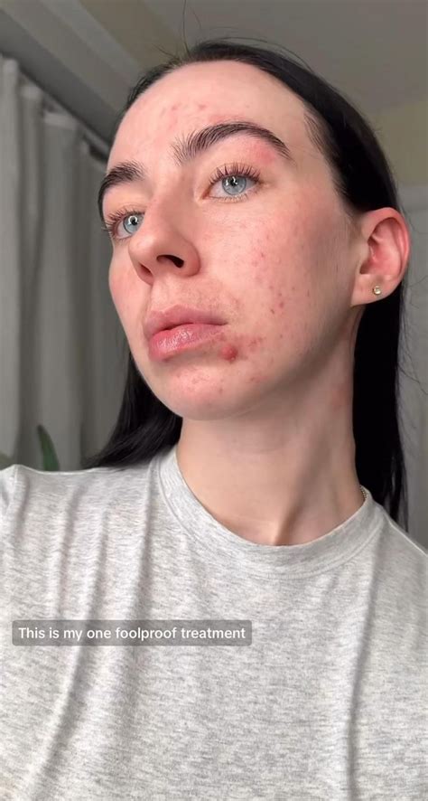 Mighty Patch™ Original Patch From Hero Cosmetics The 1 Hydrocolloid