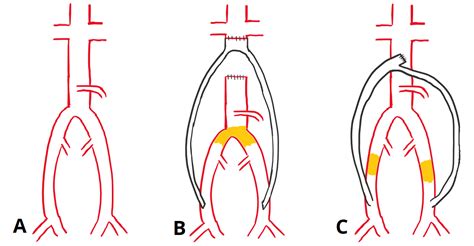 Consent Arterial Bypass Teachmesurgery