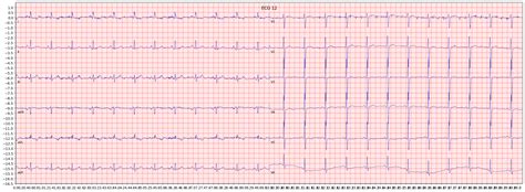 examples of non specifc ischemic isc ecg library