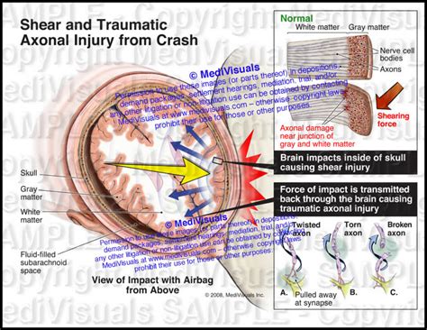 Diffuse Axonal Injury Mechanism