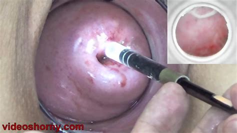Endoscope With Camera Is Inserted Into The Cervix To See Inside Eporner