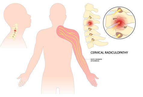 Understanding Cervical Radiculopathy Causes Symptoms And Treatment