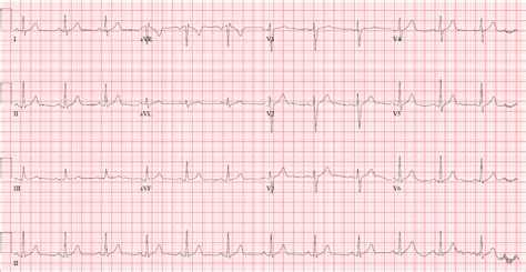 Electrocardiogram Ecg Or Ekg Icardio