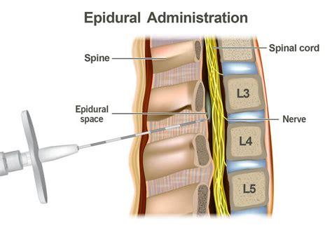 Epidural Needle Types