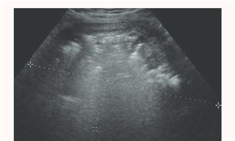 Patient Number 2 Transvaginal Ultrasound Enlarged Heterogeneous